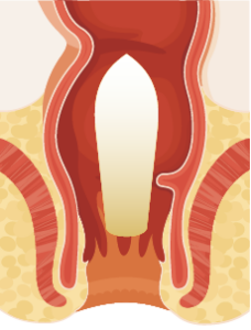 Enemas or suppositories | QSCIS