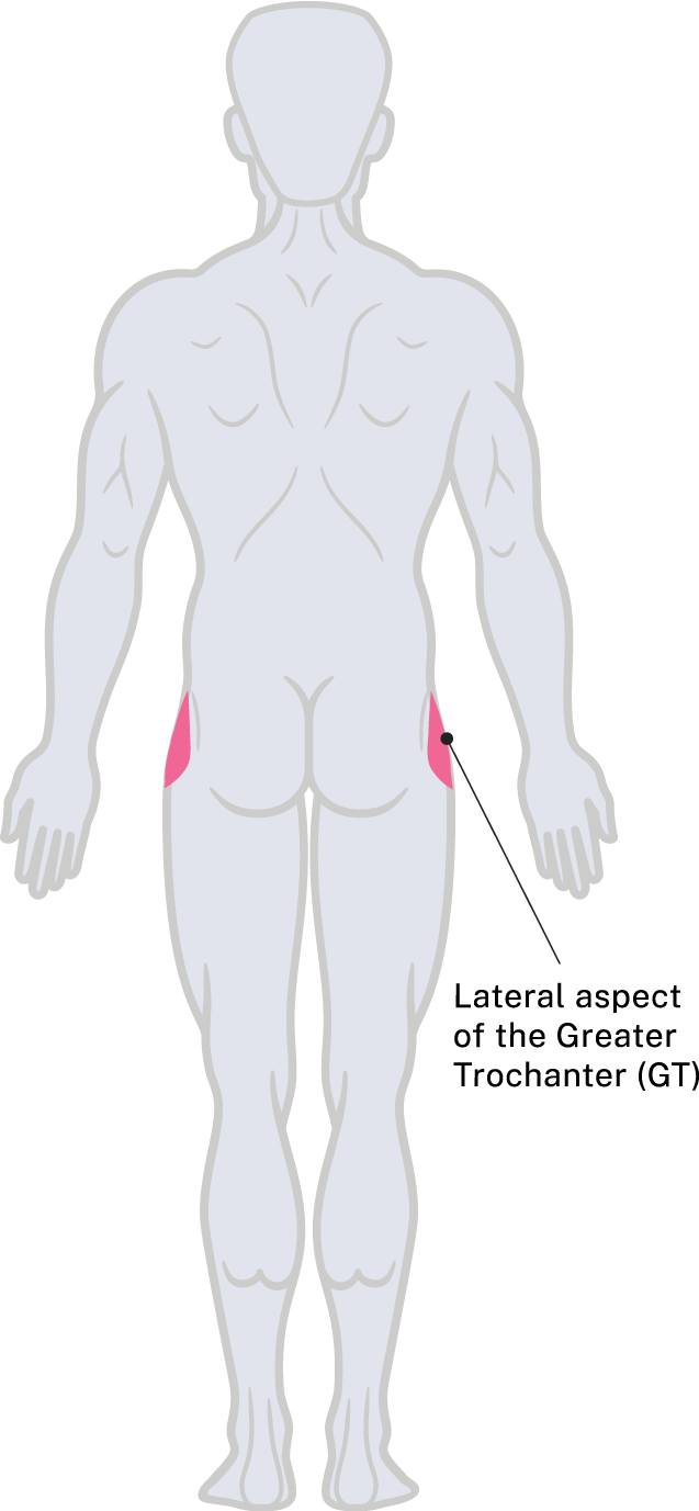 Lateral aspect of the greater trochanter | QSCIS