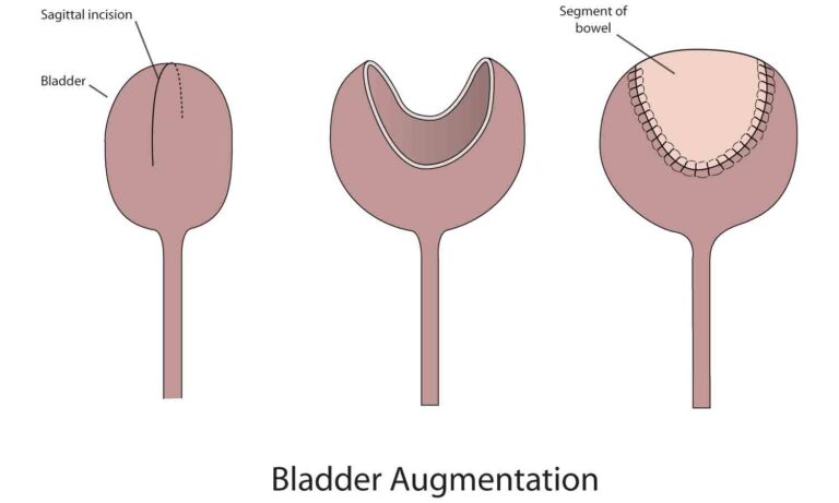 Surgical options for bladder management | QSCIS