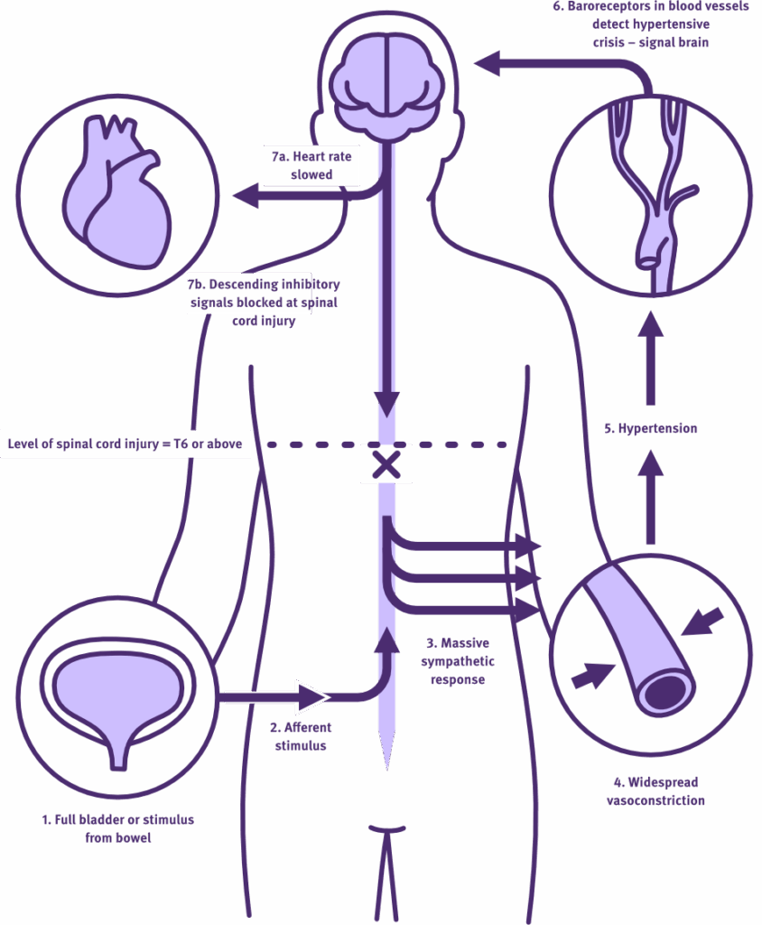 Autonomic dysreflexia | QSCIS